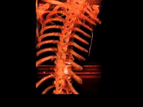 Thoracotomy for Exposure of the Spine