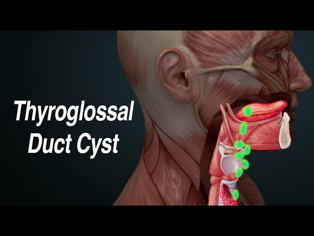 Thyroglossal Duct