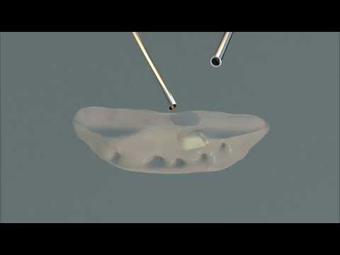 Osseous cyst-like lesions of the navicular bone - Supplementary video [ID 399835]