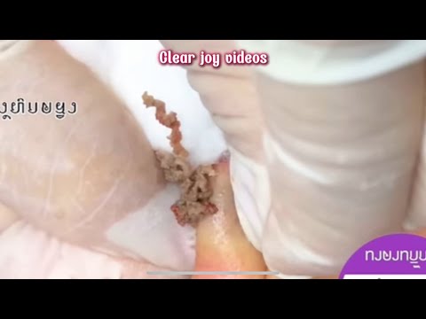 Big Cystic Acne Blackheads Extraction Blackheads & Milia, Whiteheads Removal Pimple Popping