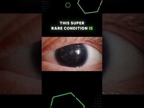The Rarest Eye Color in the World!