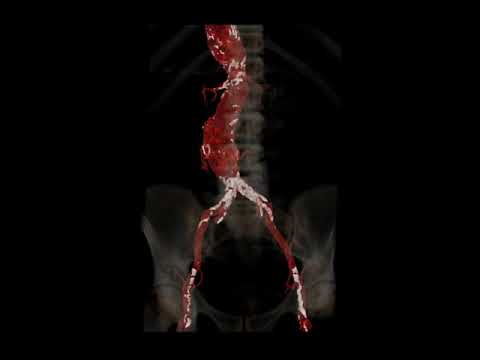 aortic aneursym