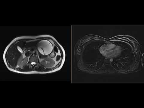 Hepatic mucinous cystic neoplasm