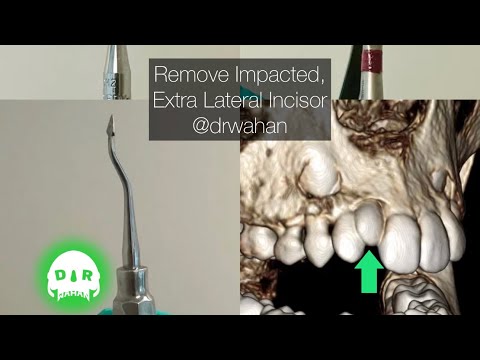 Step by Step Extraction of Supernumerary Incisor @drwahan