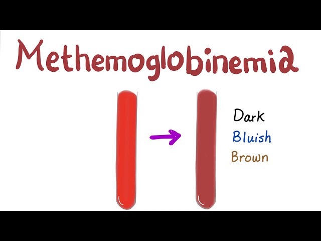 What is methemoglobinemia? Beth Matthews inquest injuries explored