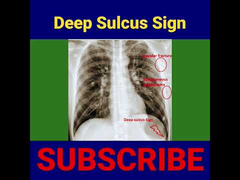 Deep Sulcus Sign - Pneumothorax - Supine X ray - Radiology Review