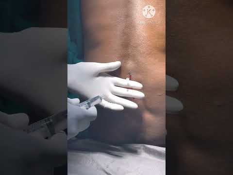 How to give spinal Anesthesia? 💉