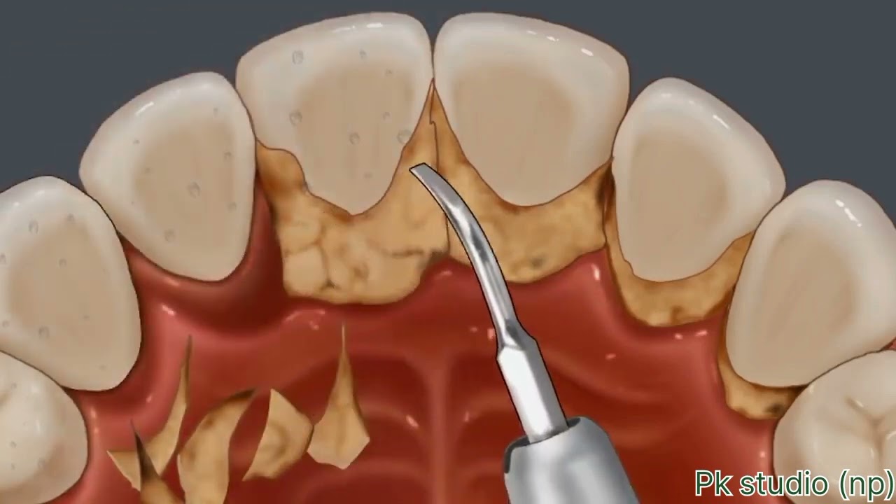 ASMR - Dental Teeth scaling/tartar teeth/ tartar removal/dental care animation video
