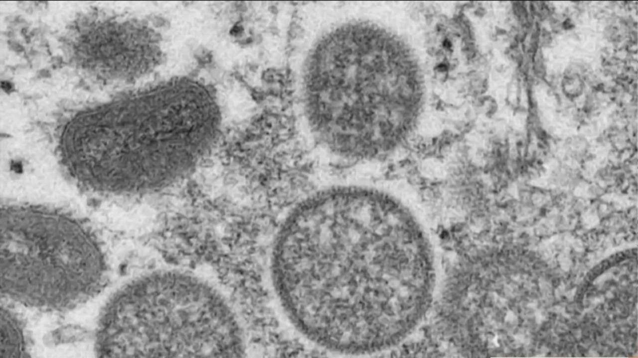 US declares public health emergency over monkeypox outbreak