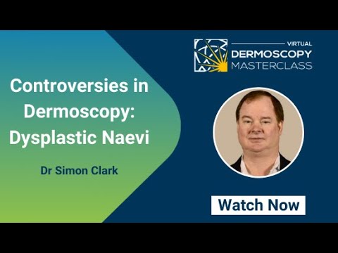 Controversies in dermoscopy Dysplastic naevi - Dr Simon Clark - Virtual Dermoscopy Masterclass