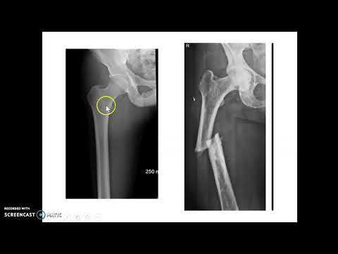 Femur x-ray protocol