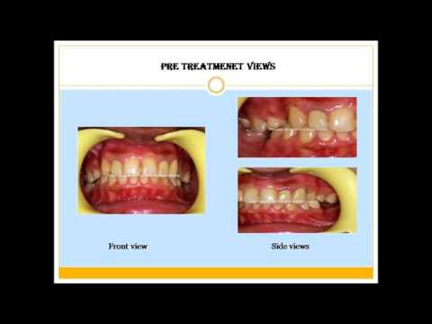 basal dental implant treatment in chennai