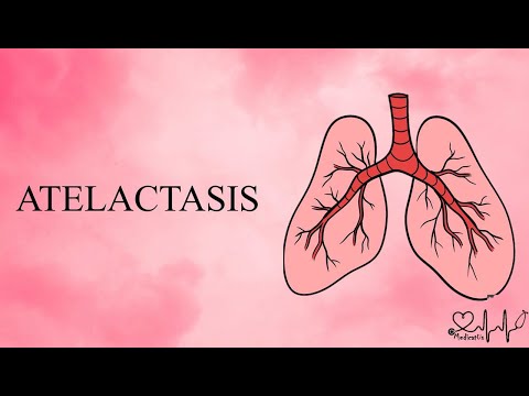ATELECTASIS - types and causes