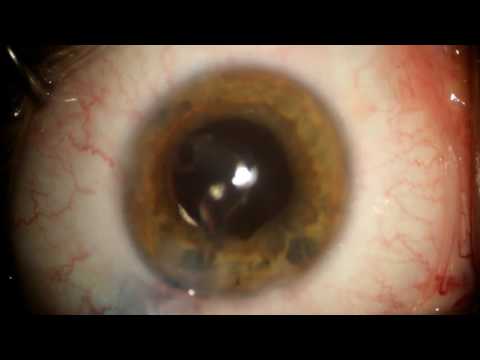 Novel device designed for pupil dilation, stabilization in IFIS cases