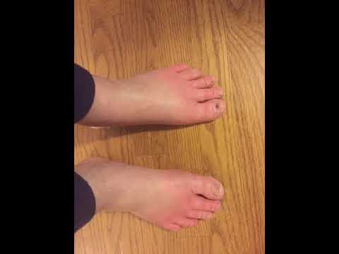Images of full body CRPS type II (RSD)
