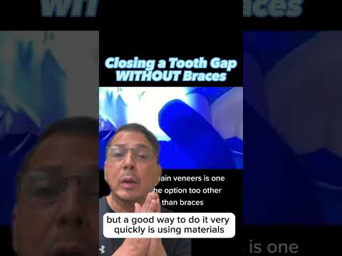 A QUICK Way Dentists Can Close a Front Tooth Gap | View Mobile Dental #shorts