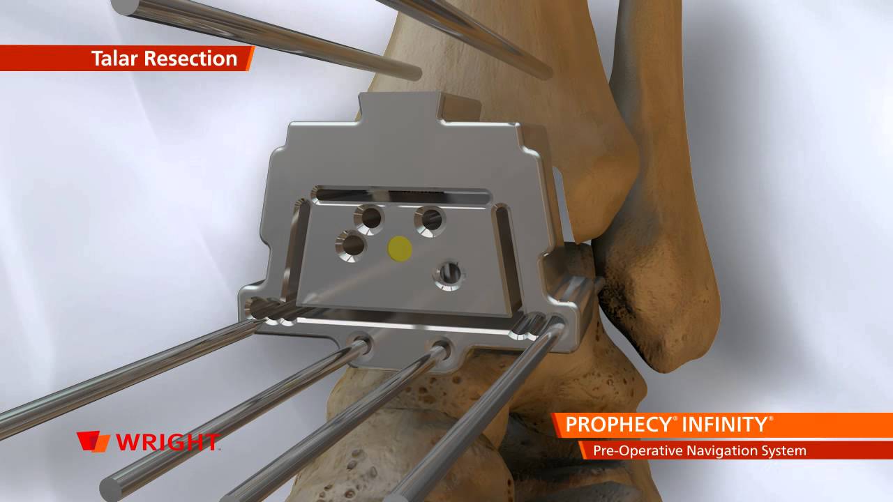 PROPHECY™ INFINITY™ Preoperative Navigation System Animation