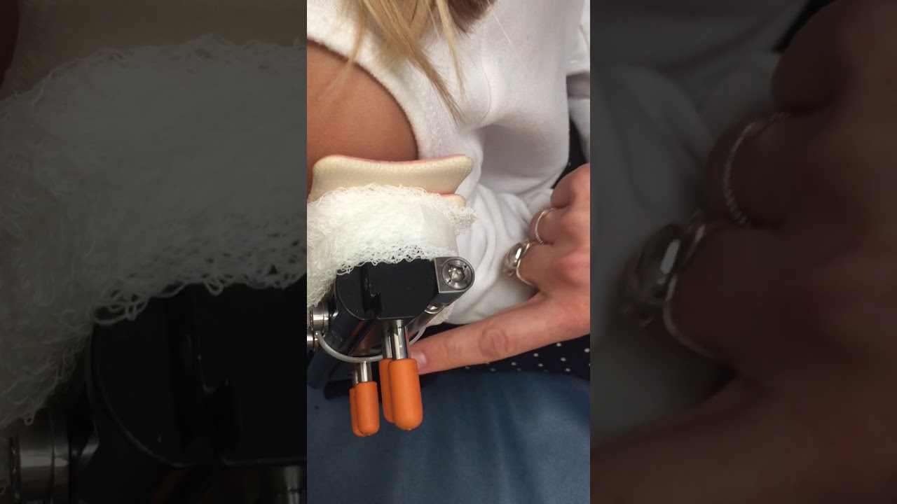 Turns for monolateral Orthofix external fixator