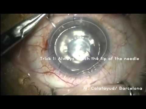 Transfixing suture in DSAEK | Marta Calatayud MD PhD