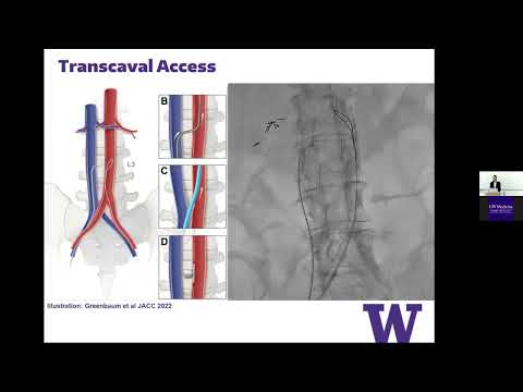 Applications of TranscatheterElectrosurgery