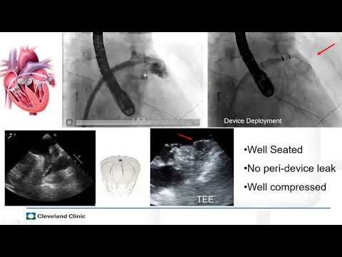 LAA Closure: Addressing the Unmet Needs for AF Patients