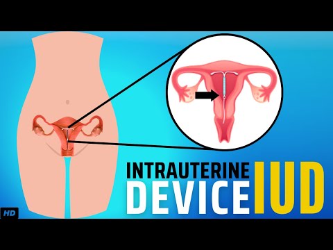 Intrauterine Device IUD: Everything You Need To Know