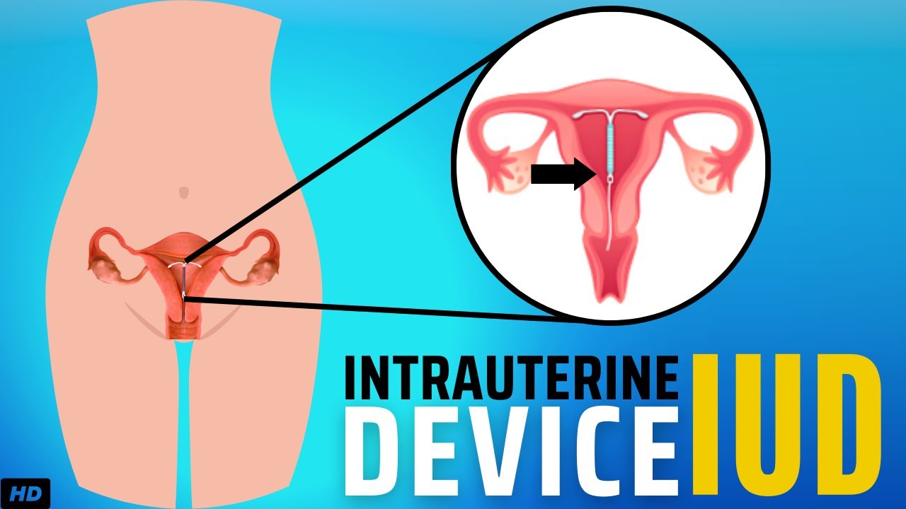 Intrauterine Device IUD: Everything You Need To Know