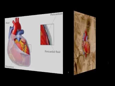 Dressler's Syndrome