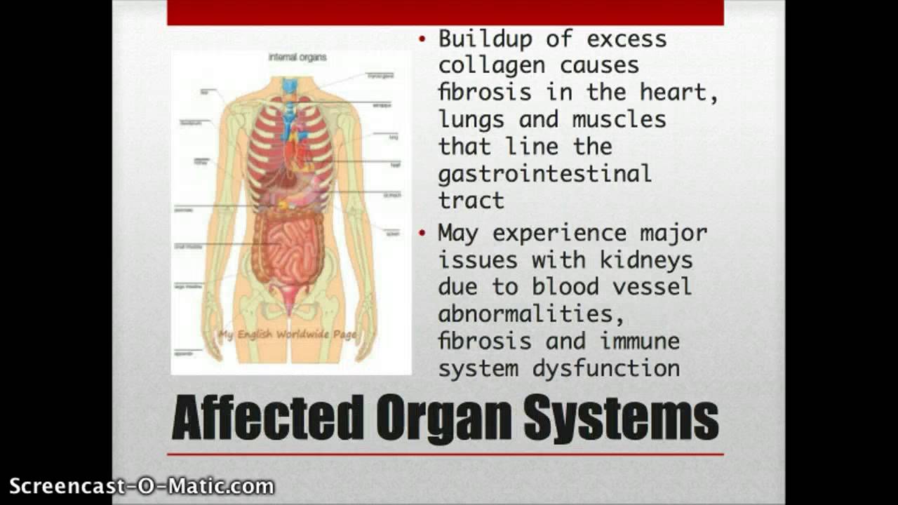 Scleroderma Powerpoint