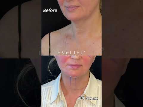 Amazing EVE Lift™ Results | Eden Plastic Surgery: Dr. Ali Charafeddine, MD
