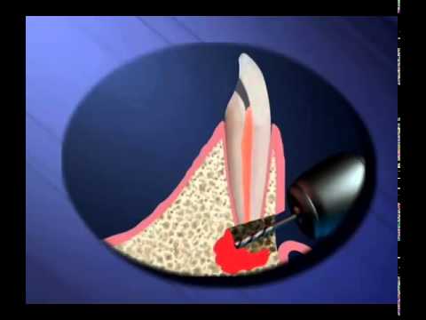 Apioectomy