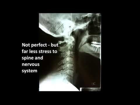 Can a reverse neck curve cause shoulder pain?