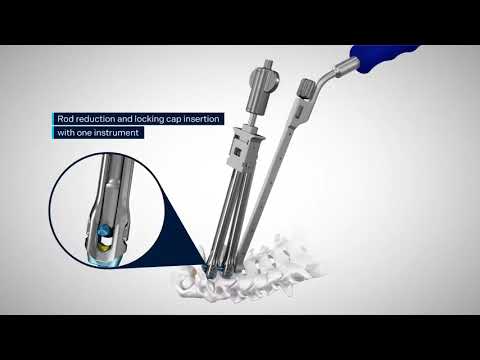 Globus Medical: QUARTEX™ MIS