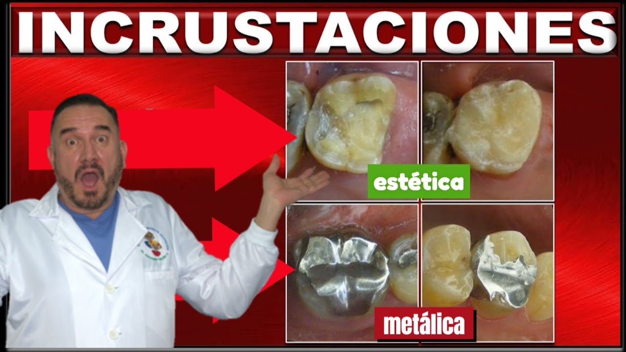 DESCUBRE las INCRUSTACIONES Dentales: Todo lo Que Necesitas Saber!