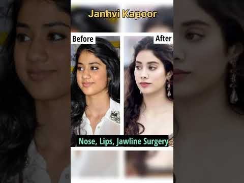 Shocking Plastic Surgery Look of Bollywood Actress #shorts #bollywood #actress #topview