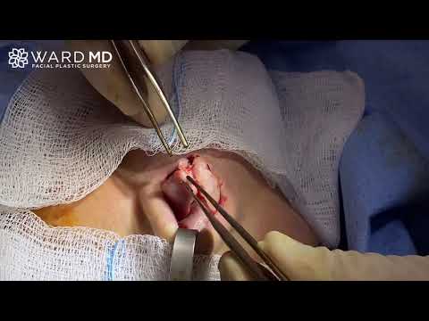 Nose Job Anatomy