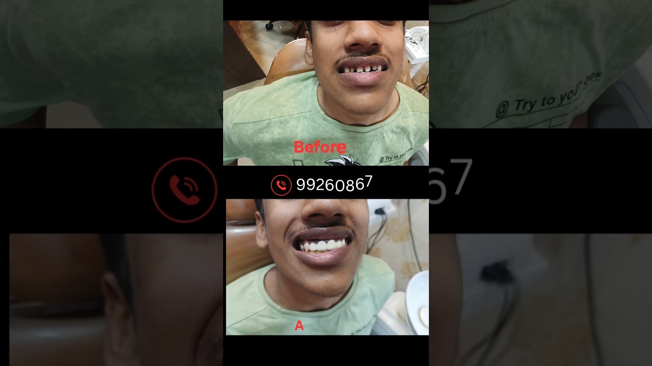 fix teeth |Dental crown in Indore|Best dental clinic in indore