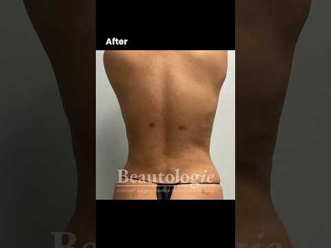Liposuction of the back and flanks before and after 🤩