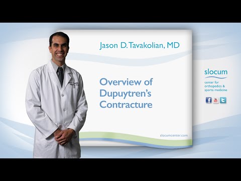 Overview of Dupuytren’s Contracture