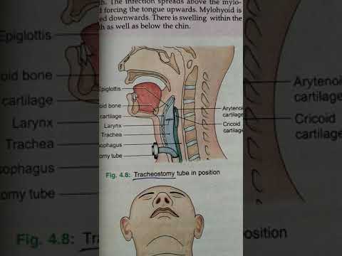 Tracheostomy #pronunciation