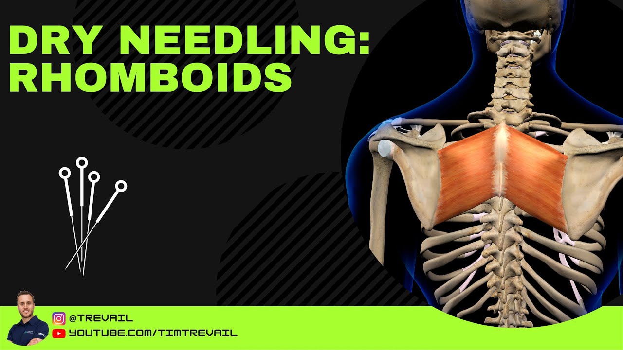 Dry Needling: Rhomboids
