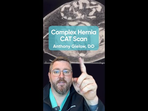 Complex Hernia CAT Scan | Dr. Anthony Gielow