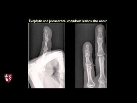 Introduction to Cartilage Tumors