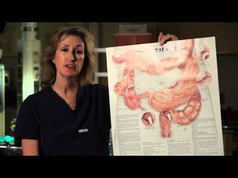 What is Colorectal Cancer? - Mayo Clinic