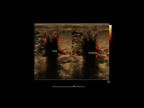 Varicocele || Ultrasound || Doppler || Case 20