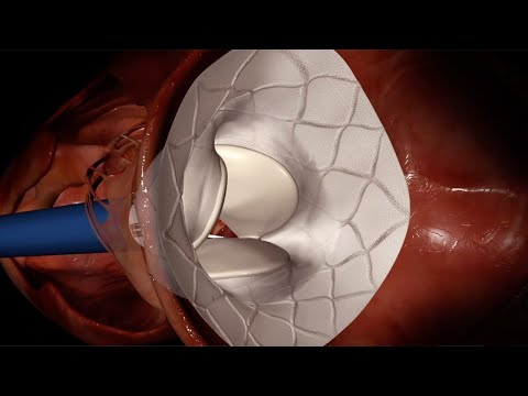 Minimally-Invasive Tendyne TMVR: How It Works?
