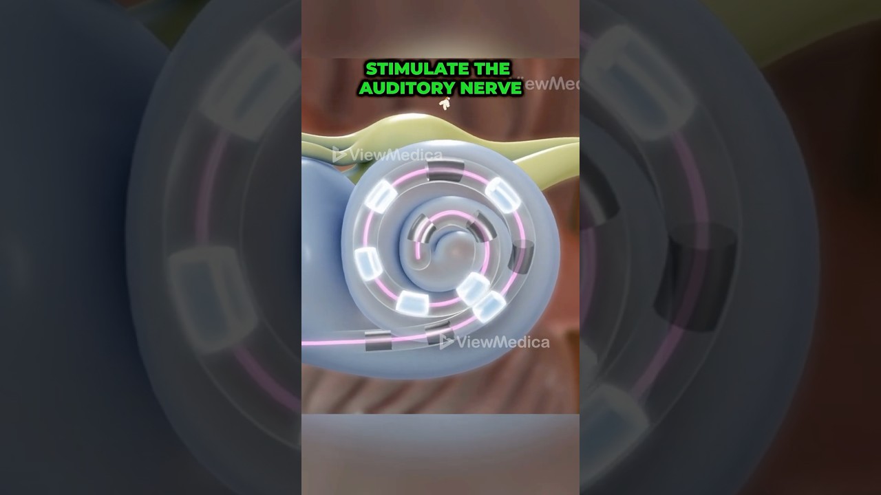 How cochlear implants work (3D Animation)