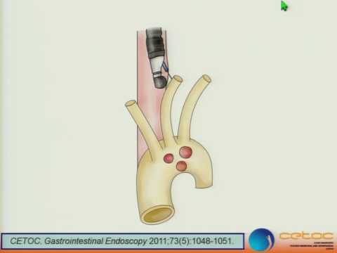 EUS-FNA in Lung Cancer Staging