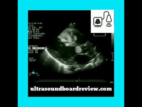 Rhabdomyoma Tumors
