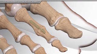 Patient Education in Orthopedic Surgery – OrthoPedia Patient